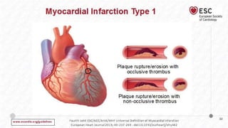2018 4th universal def of myocardial infarction slides | PPTX