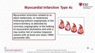 2018 4th universal def of myocardial infarction slides | PPTX