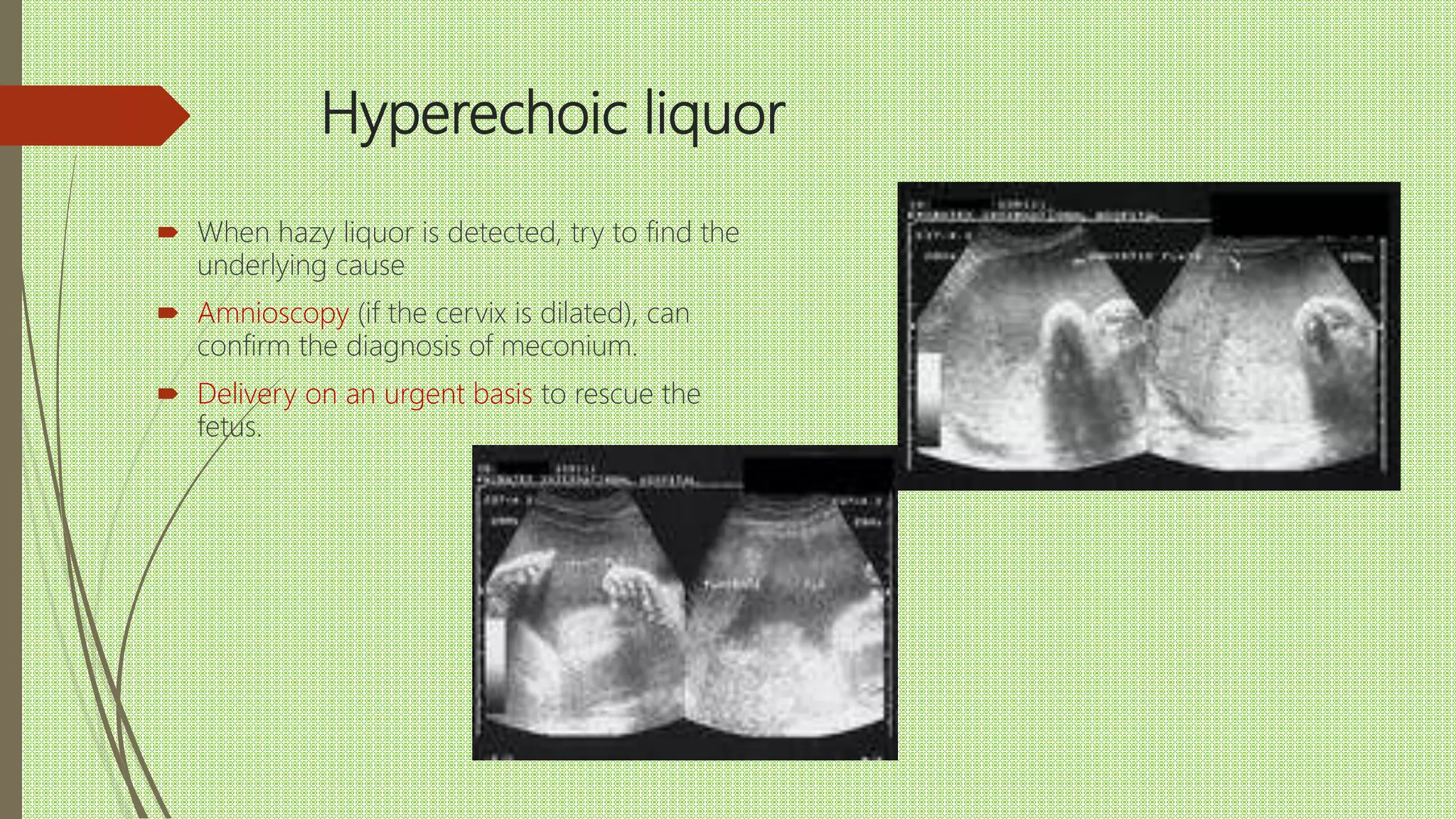 amniotic fluid normal and abnormal | PPTX