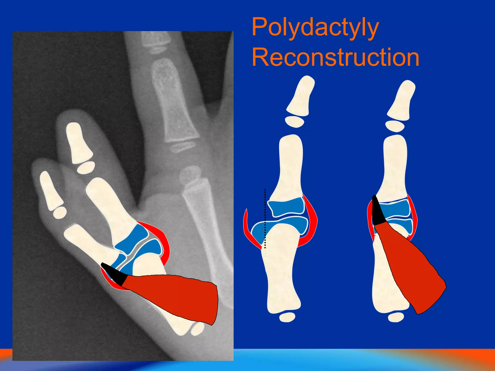 Congenital Hand Surgery | PPT