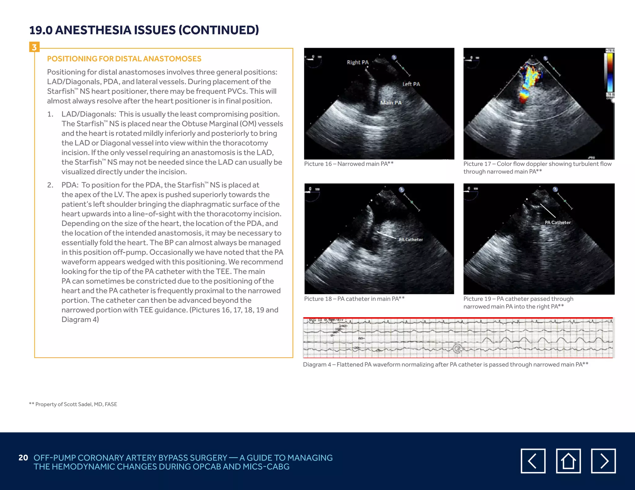 OFF-PUMP CORONARY ARTERY BYPASS SURGERY A GUIDE TO MANAGING THE ...