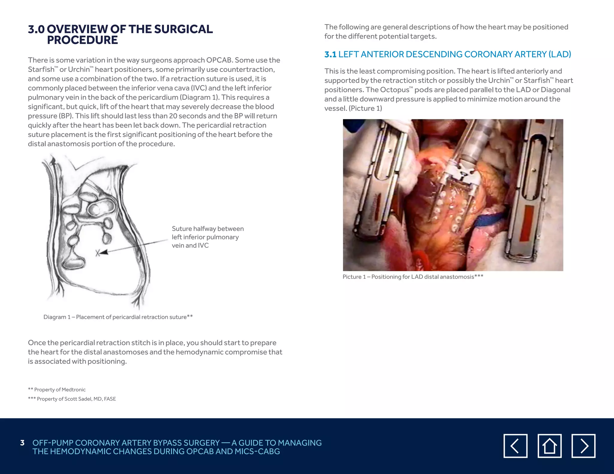 OFF-PUMP CORONARY ARTERY BYPASS SURGERY A GUIDE TO MANAGING THE ...