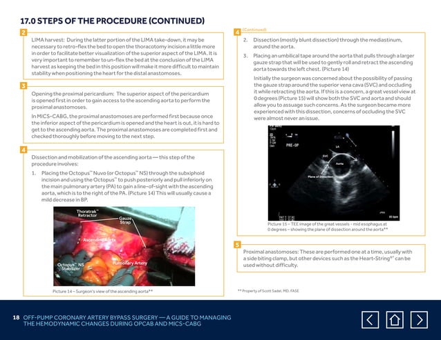 OFF-PUMP CORONARY ARTERY BYPASS SURGERY A GUIDE TO MANAGING THE ...