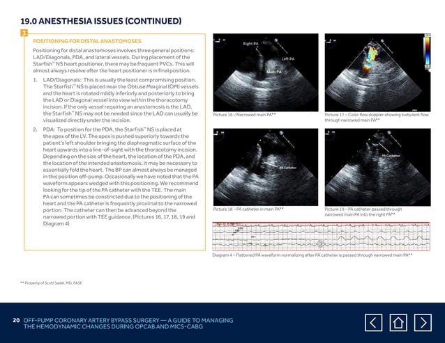 OFF-PUMP CORONARY ARTERY BYPASS SURGERY A GUIDE TO MANAGING THE ...