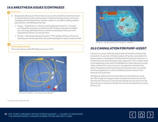 OFF-PUMP CORONARY ARTERY BYPASS SURGERY A GUIDE TO MANAGING THE ...