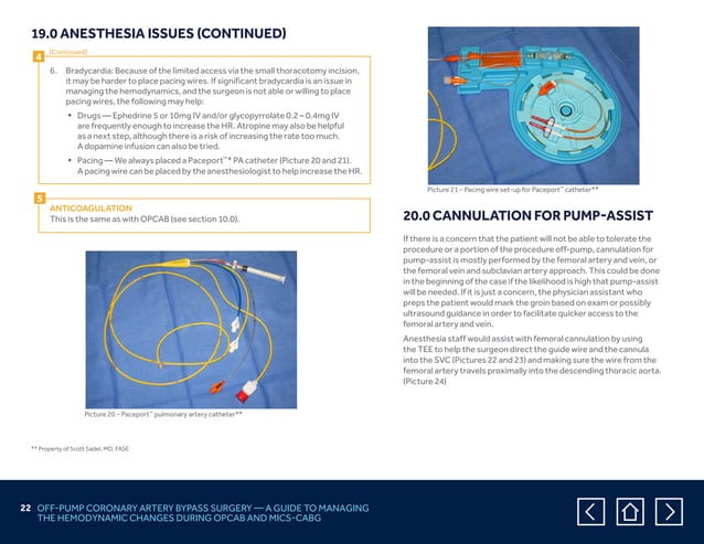 OFF-PUMP CORONARY ARTERY BYPASS SURGERY A GUIDE TO MANAGING THE ...