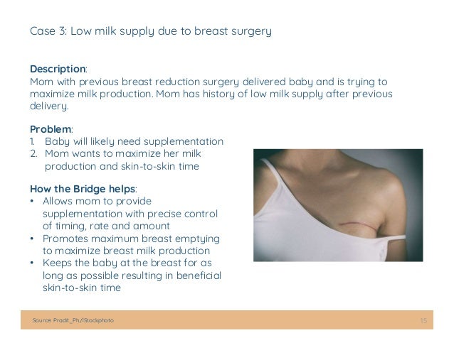 Introduction to the "Bridge" - a new breastfeeding support tool