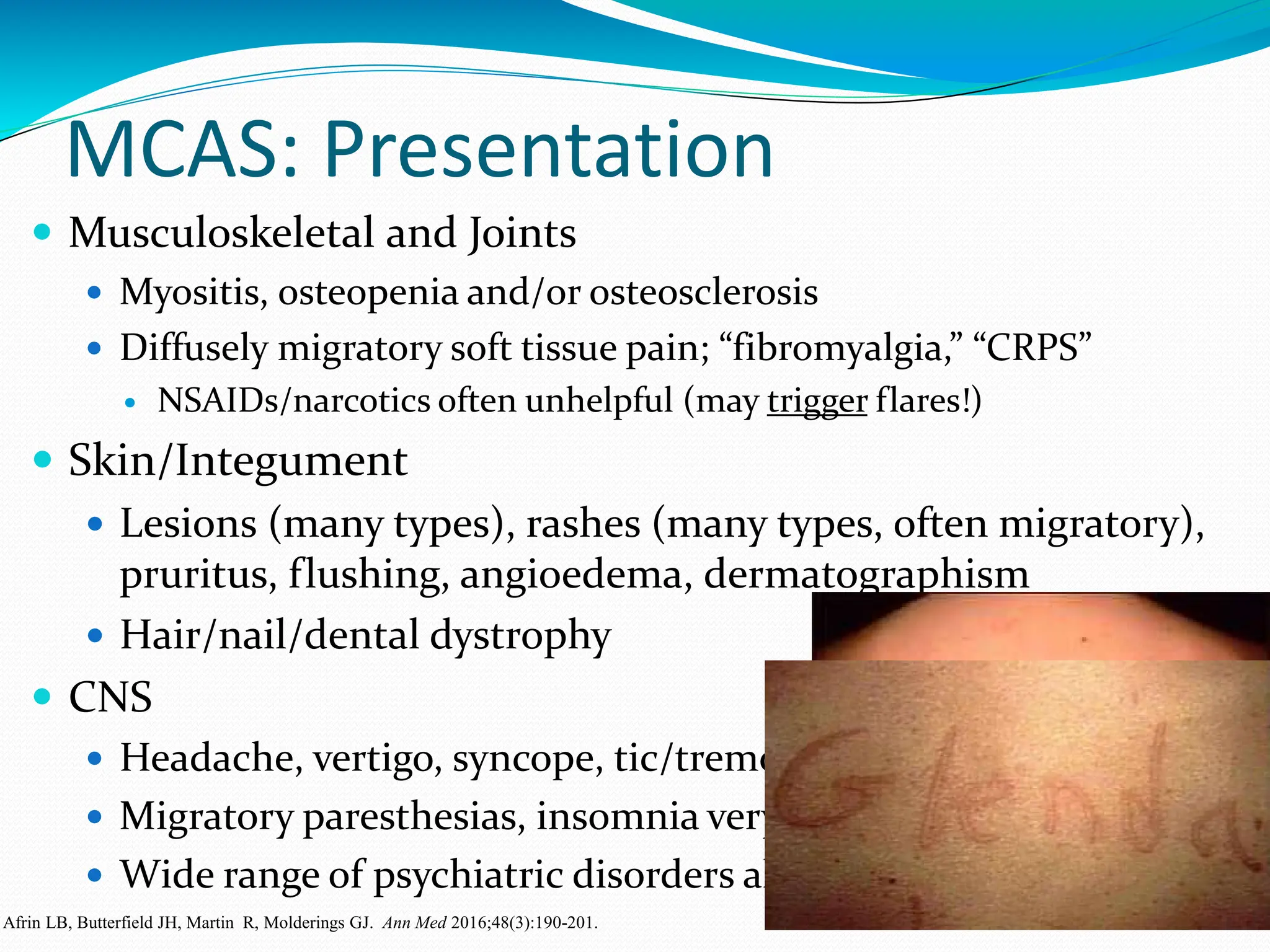 2019 Afrin Mast Cell Activation Syndrome.pdf