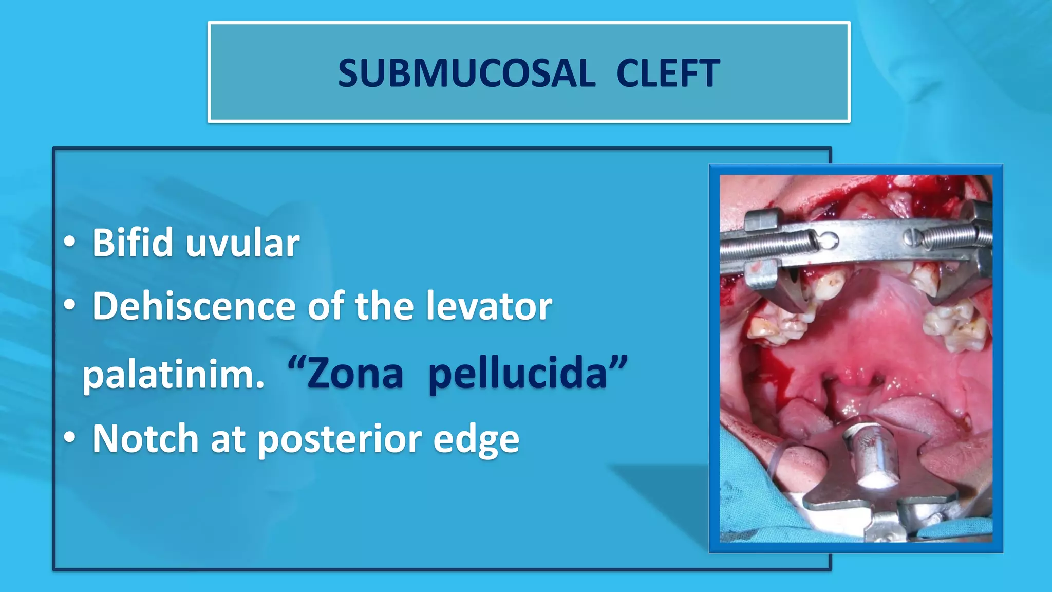Slide Cleft Lip and Palate | PDF