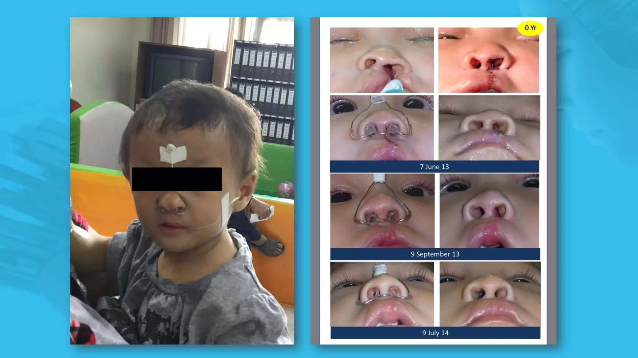 Slide Cleft Lip and Palate | PDF