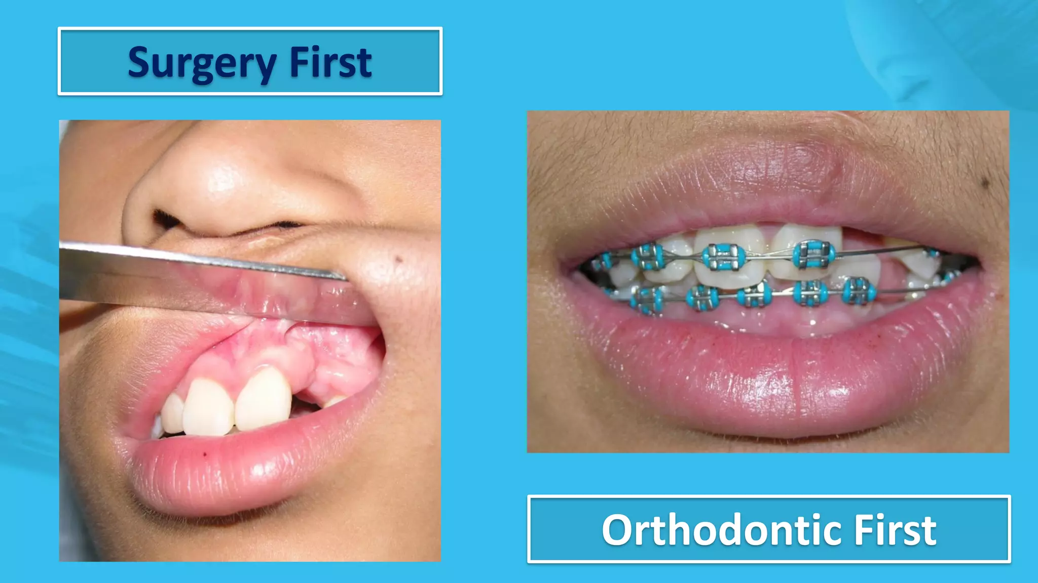 Slide Cleft Lip and Palate | PDF