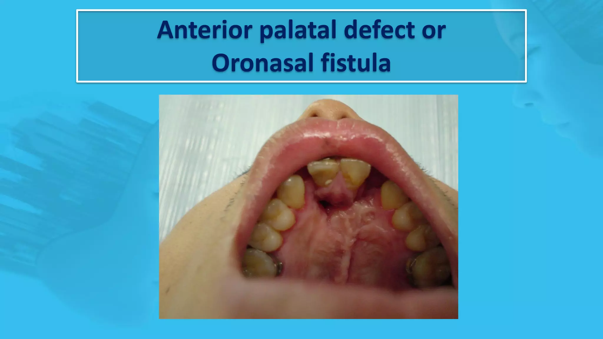 Slide Cleft Lip and Palate | PDF
