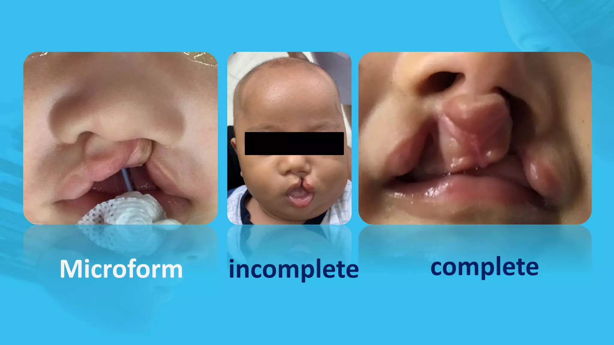 Slide Cleft Lip and Palate | PDF