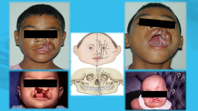 Slide Cleft Lip and Palate | PDF