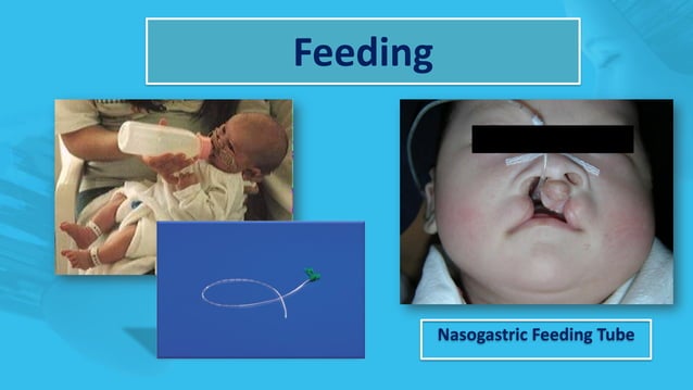 Slide Cleft Lip and Palate | PDF