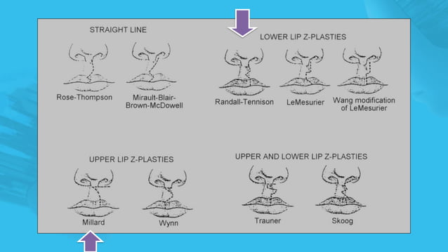 Slide Cleft Lip and Palate | PDF