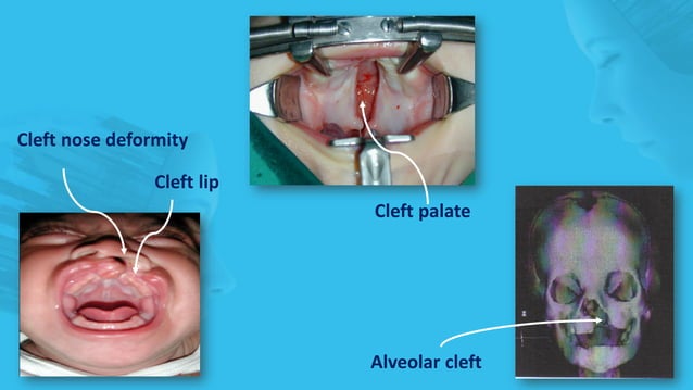 Slide Cleft Lip and Palate | PDF