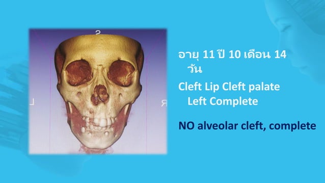 Slide Cleft Lip and Palate | PDF