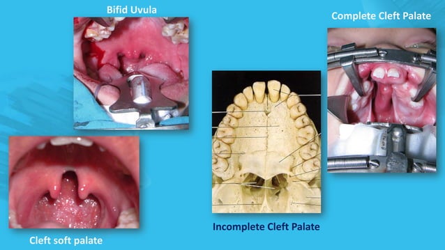 Slide Cleft Lip and Palate | PDF