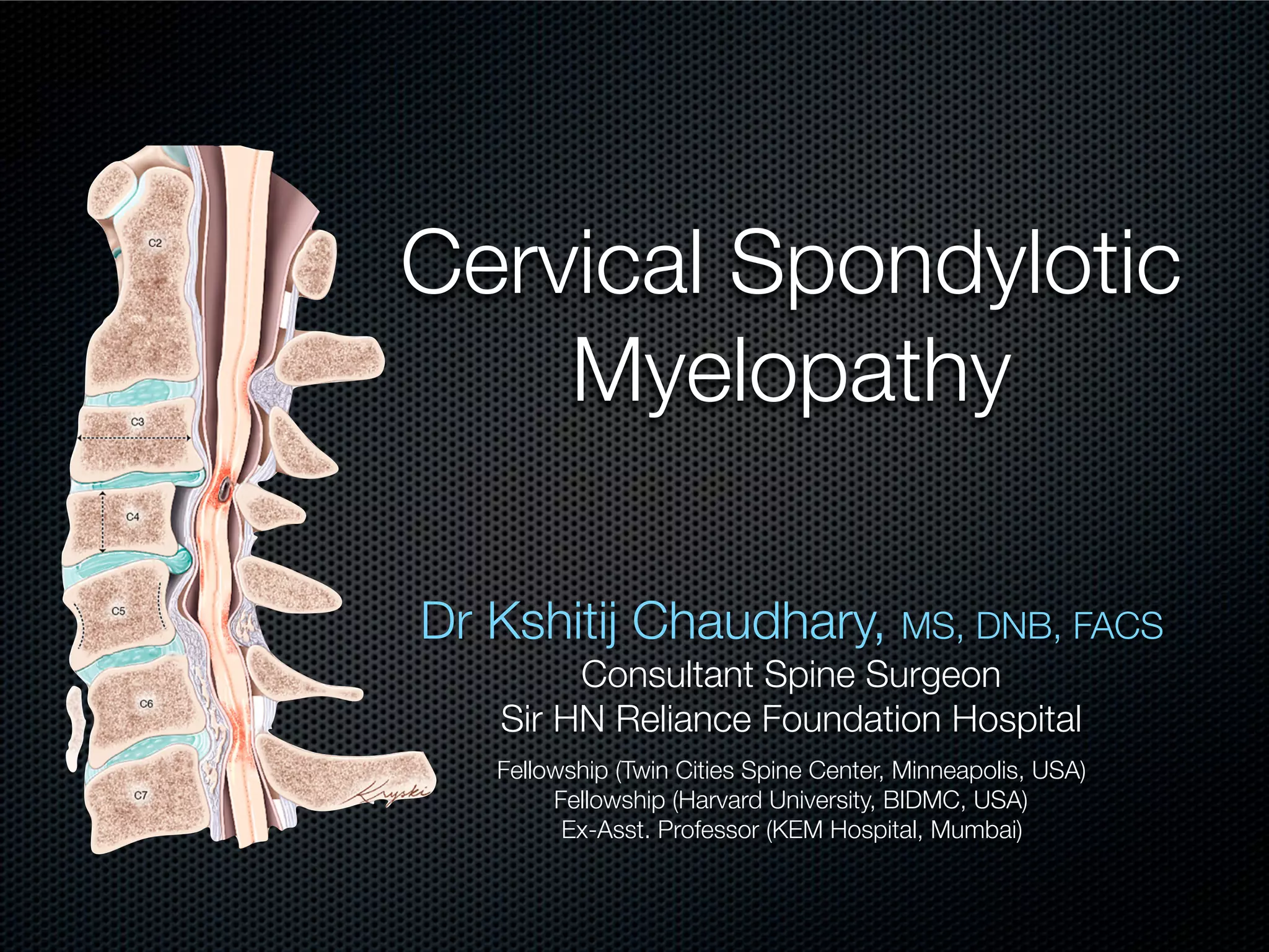Cervical spondylotic myelopathy | PDF