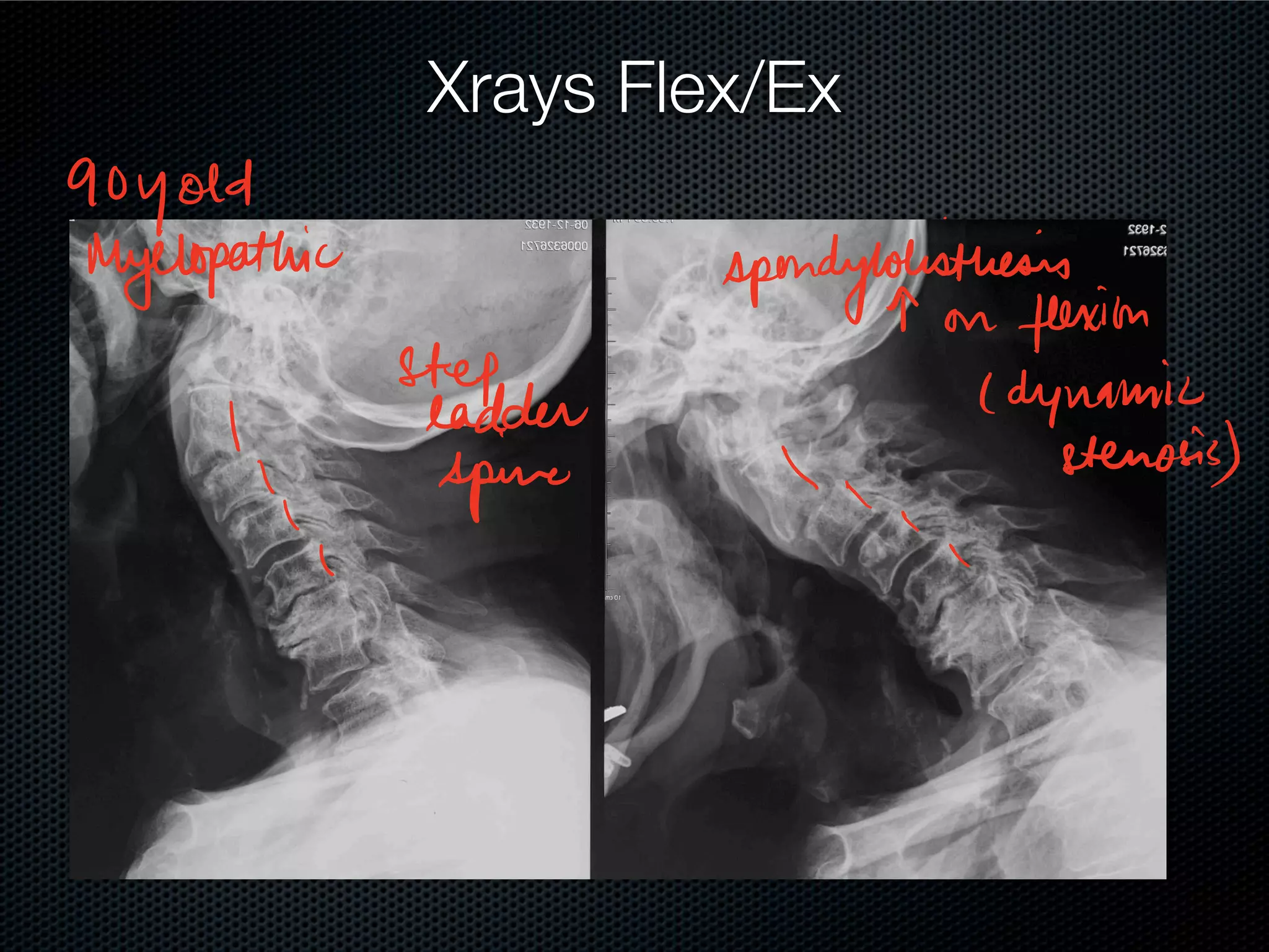 Cervical spondylotic myelopathy | PDF