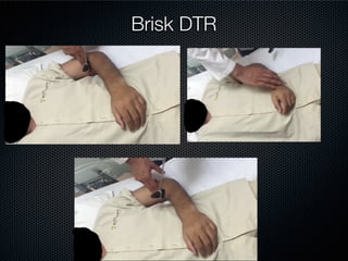 Cervical spondylotic myelopathy | PDF