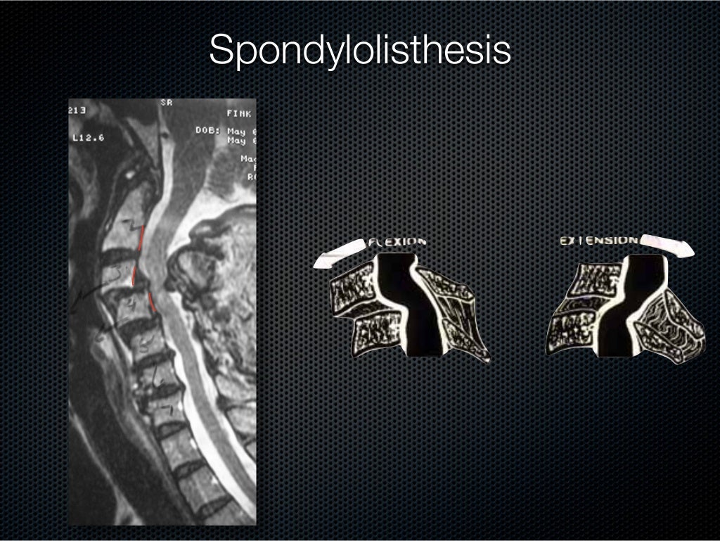 Cervical Spondylotic Myelopathy