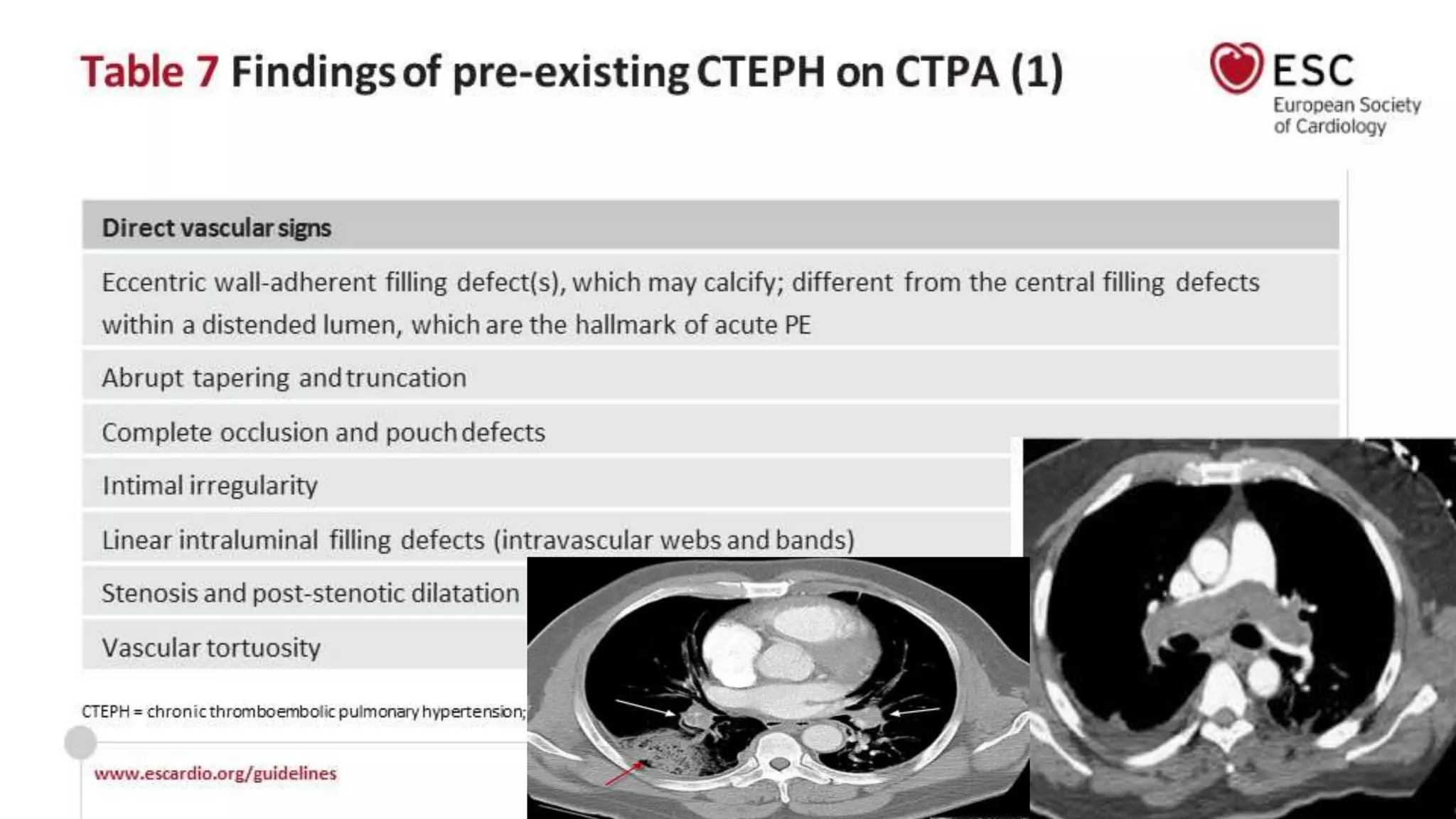 2019 ESC guidelines for pulmonary embolism | PPTX