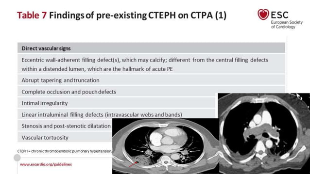 2019 ESC guidelines for pulmonary embolism | PPTX | Heart and ...