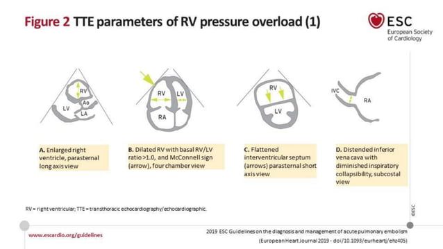 2019 ESC guidelines for pulmonary embolism | PPTX | Heart and ...