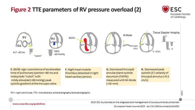 2019 ESC guidelines for pulmonary embolism | PPTX | Heart and ...