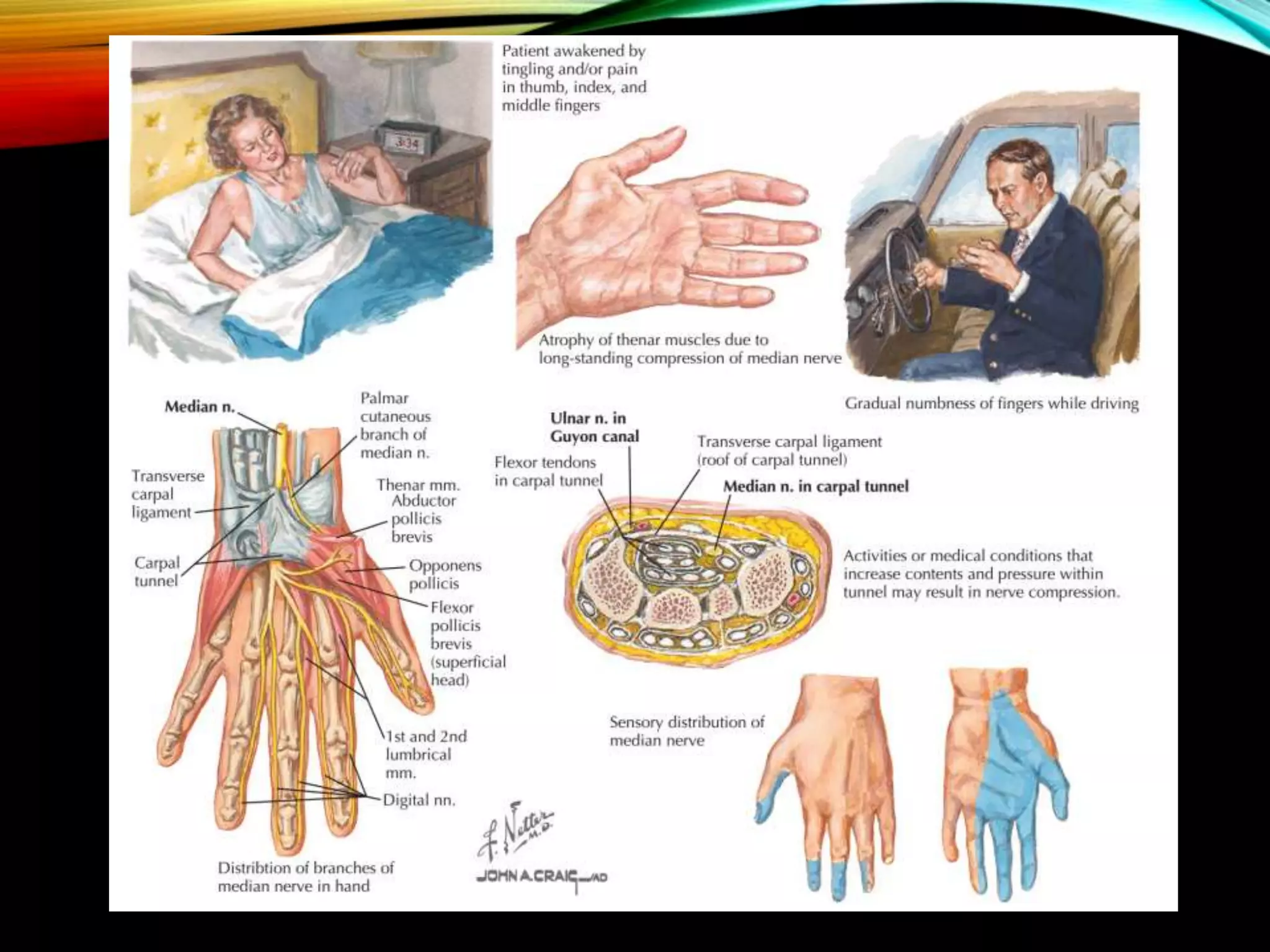 Nerve entrapment & injury for medical student (2ed) | PPTX | Death ...