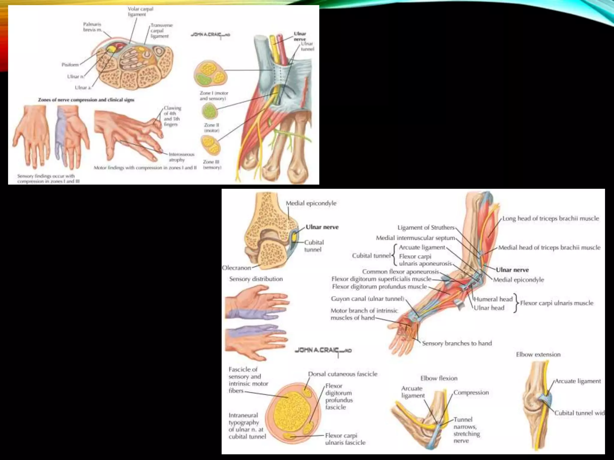 Nerve entrapment & injury for medical student (2ed) | PPTX | Death ...