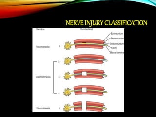 Nerve entrapment & injury for medical student (2ed) | PPTX | Death ...