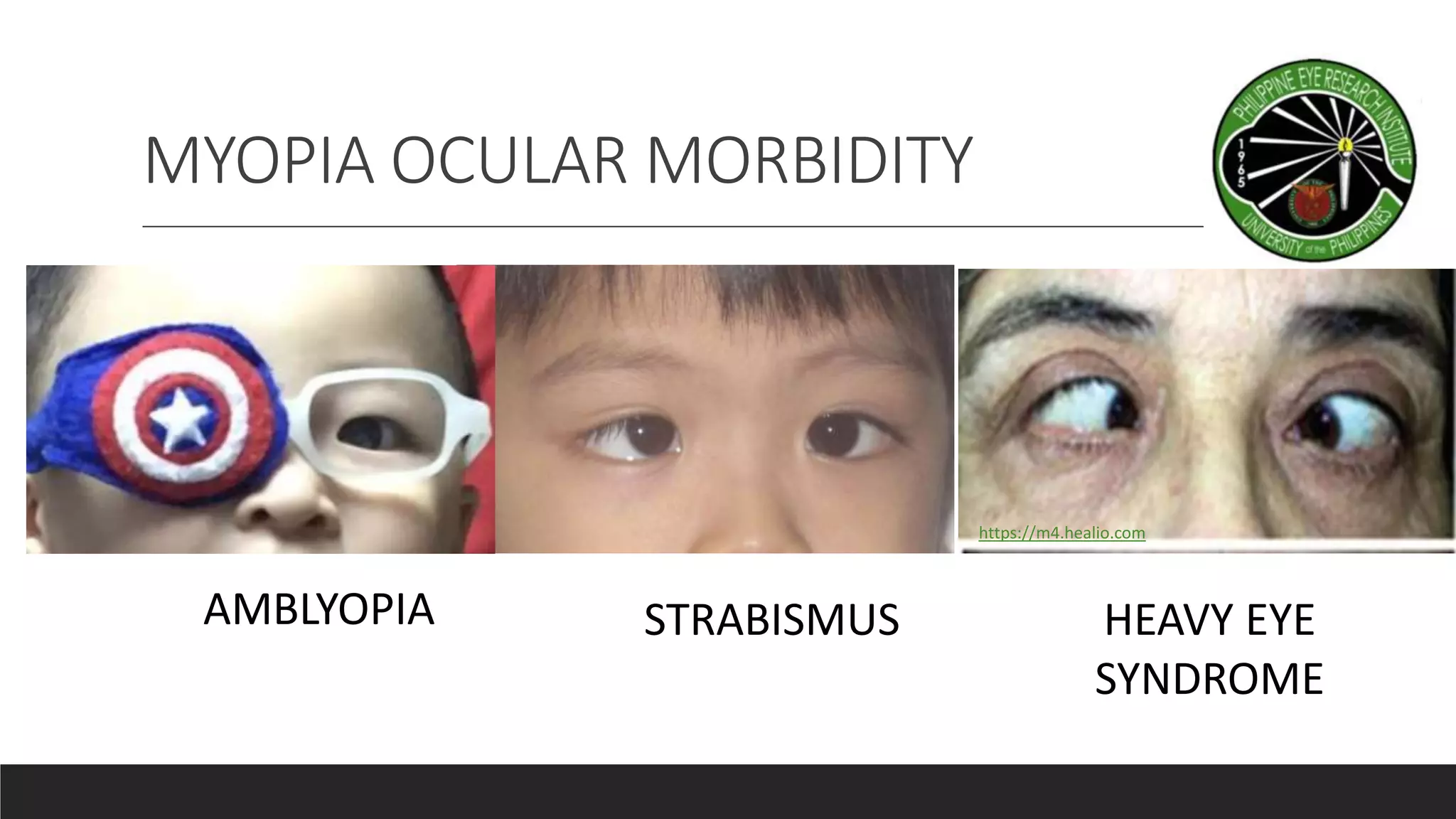Myopia: Risk Factor for Ocular Morbidity and Permanent Visual Loss | PPTX