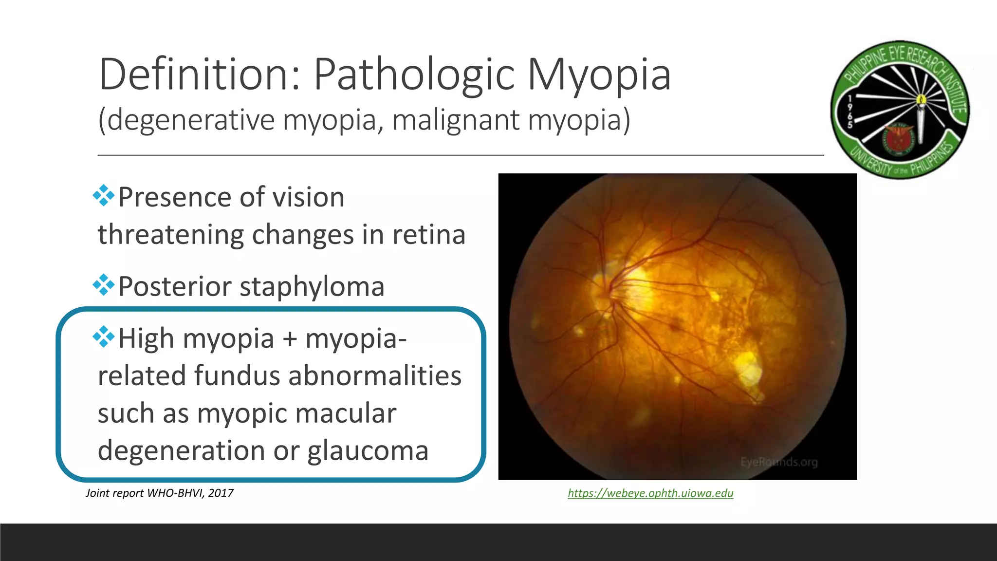 Myopia: Risk Factor for Ocular Morbidity and Permanent Visual Loss | PPTX