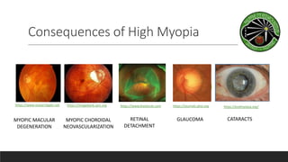 Myopia: Risk Factor for Ocular Morbidity and Permanent Visual Loss | PPTX