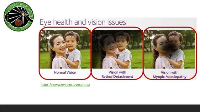 Myopia: Risk Factor for Ocular Morbidity and Permanent Visual Loss | PPTX