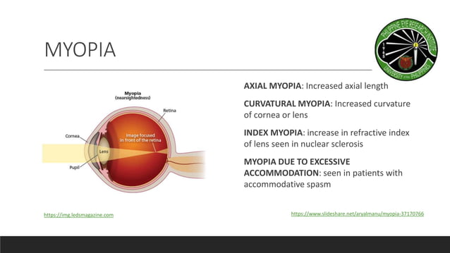 Myopia: Risk Factor for Ocular Morbidity and Permanent Visual Loss | PPTX