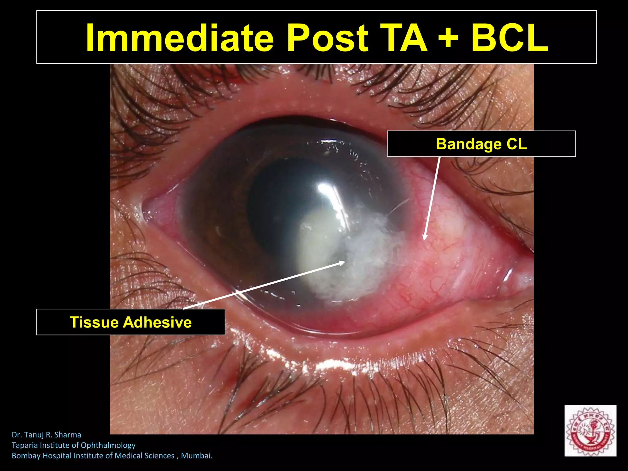 Tissue Adhesive + Bcl In Childrenwith Microbial Keratitis | PPTX