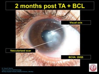 Tissue Adhesive + Bcl In Childrenwith Microbial Keratitis | PPTX