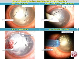 Tissue Adhesive + Bcl In Childrenwith Microbial Keratitis | PPTX