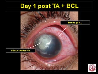 Tissue Adhesive + Bcl In Childrenwith Microbial Keratitis | PPTX