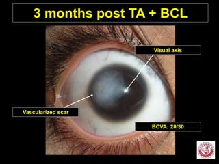 Tissue Adhesive + Bcl In Childrenwith Microbial Keratitis | PPTX