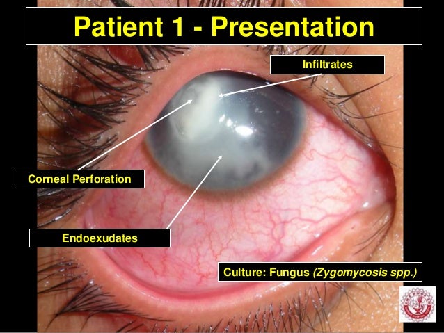 Tissue Adhesive + Bcl In Childrenwith Microbial Keratitis