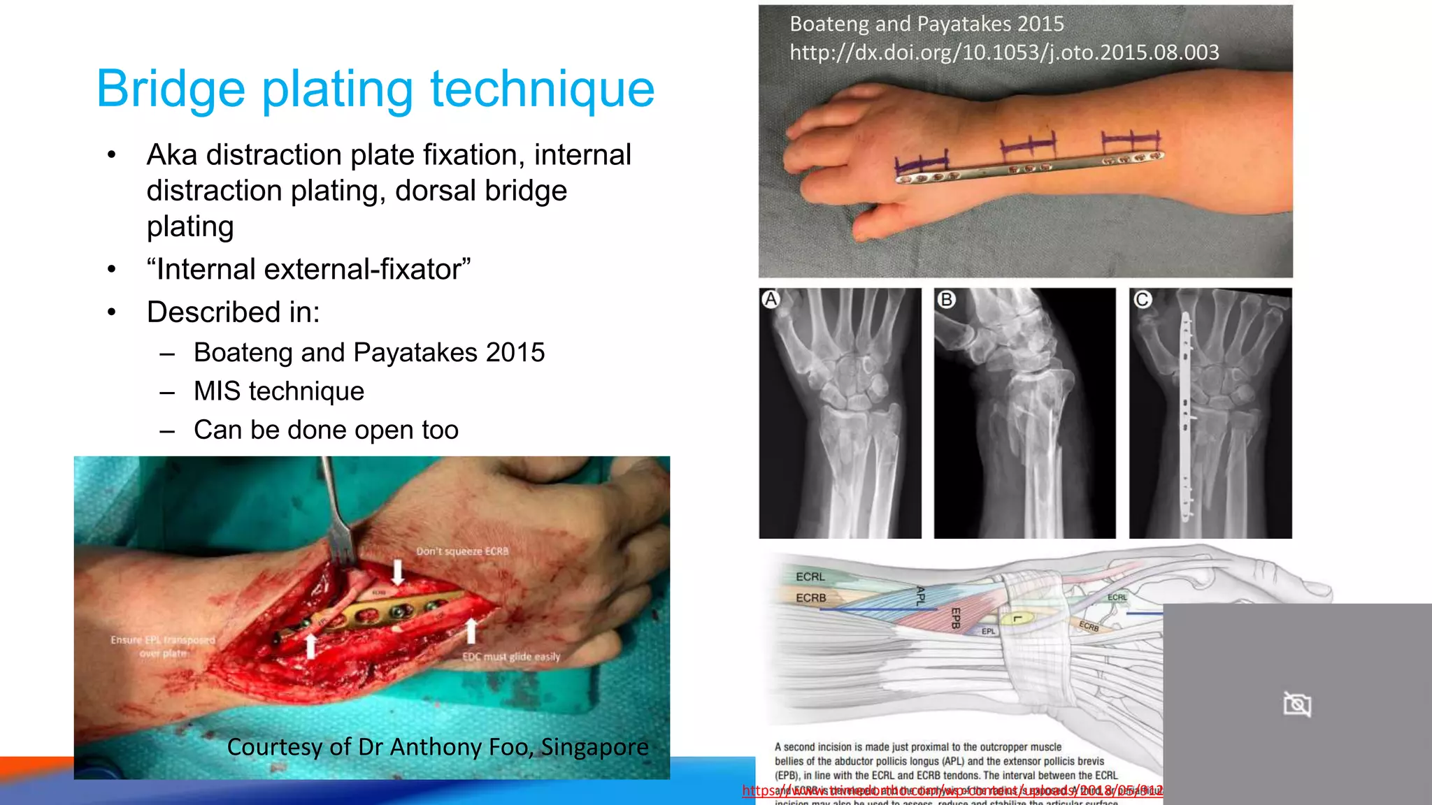High Energy Distal Radius Fractures - External fixation, Bridge plating ...