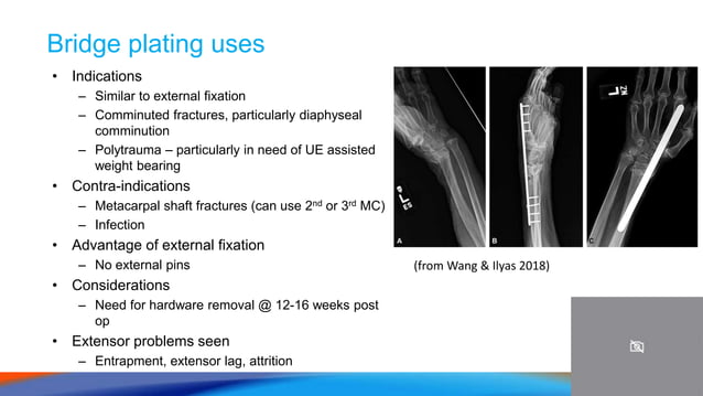 High Energy Distal Radius Fractures - External fixation, Bridge plating ...