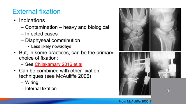 High Energy Distal Radius Fractures - External fixation, Bridge plating ...