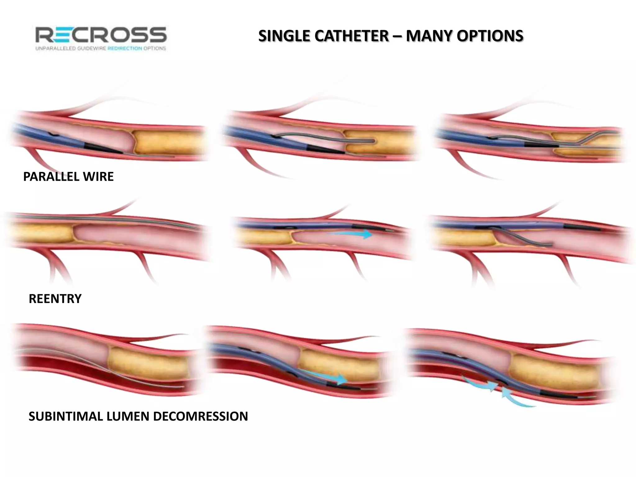 Session 3 - Microcatheters, new developments | PPTX