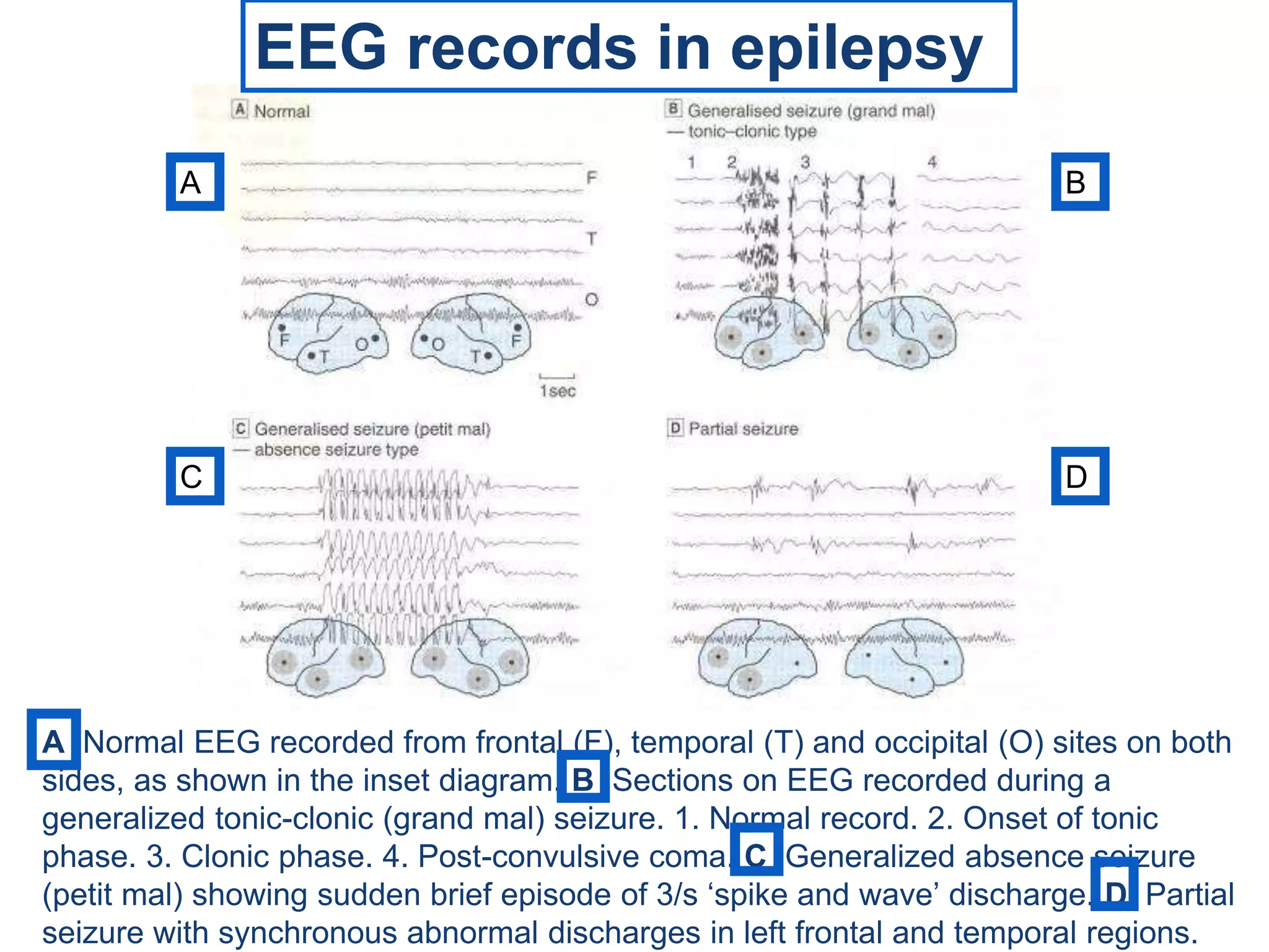 EEG FOR EPILEPSY AND ANTICONVULSIVANT DRUGS.pptx